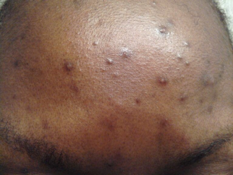 Chronic-Acne-Hormone-Imbalance-or-Not | Hair's The Thing